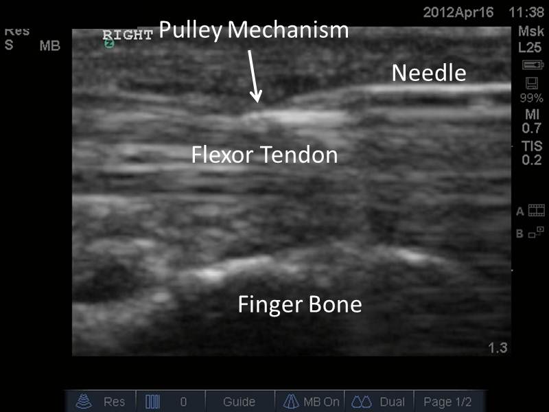 Trigger Finger Injection Helps Patient Avoid Surgery