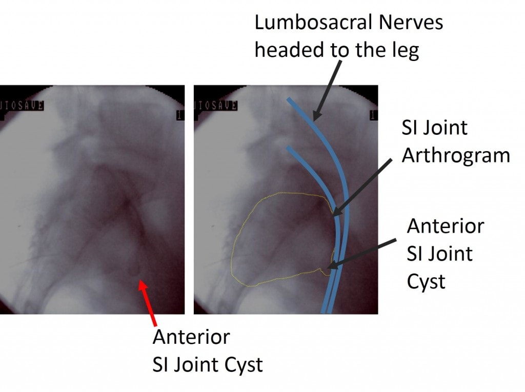 Figuring Out A Complex Patient With An SI Joint Cyst Interventional Figuring Out A Complex Patient With An SI Joint Cyst Interventional