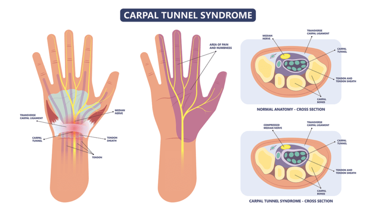 Transverse Carpal Tunnel Surgery Recovery: Does Cutting the Ligament ... Transverse Carpal Tunnel Surgery Recovery: Does Cutting the Ligament ...