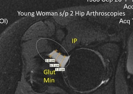 hip arthroscopy side effects