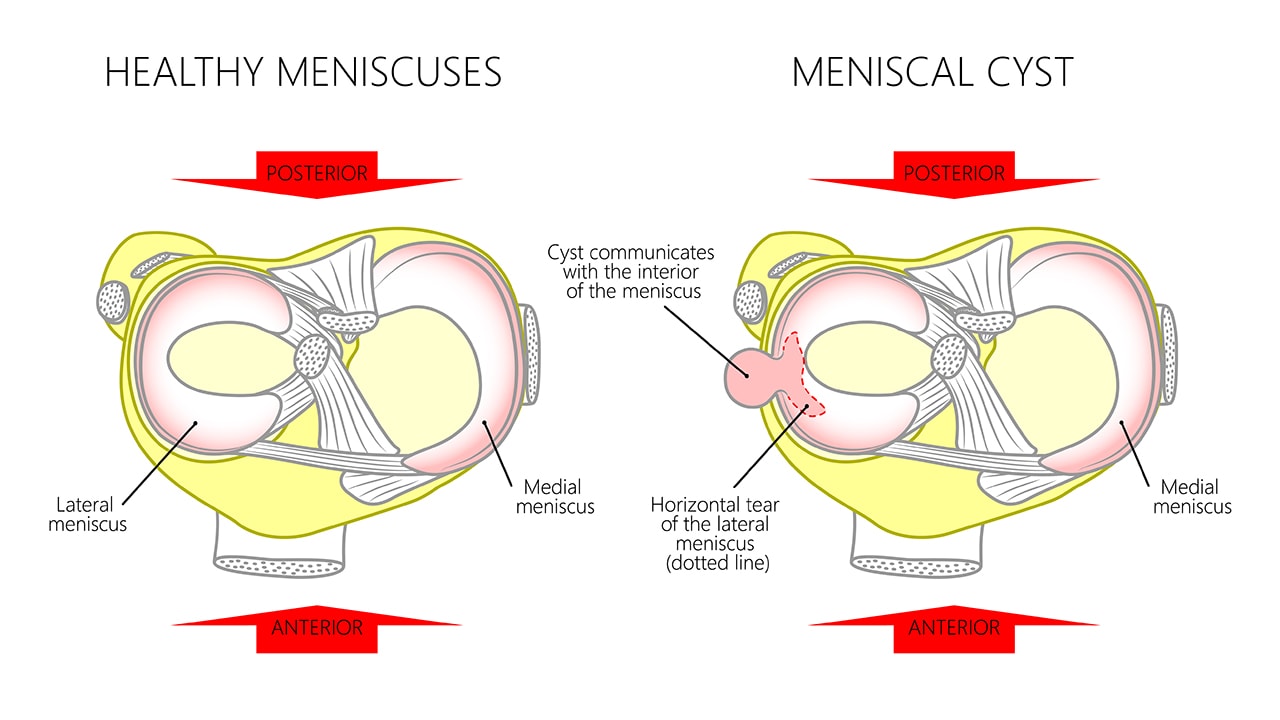What Is A Meniscal Cyst Why You Should Care About The Hole In My Meniscus Regenexx Blog