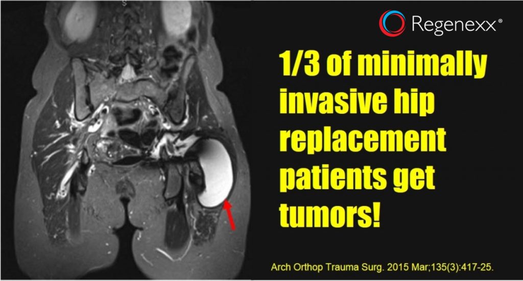 hip replacement device causes tumors