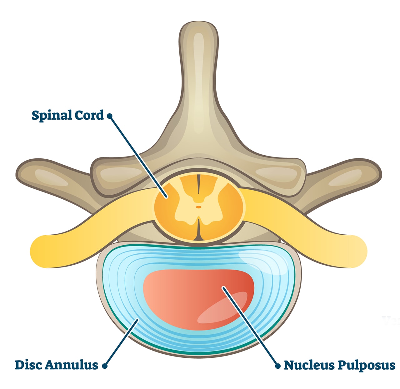 High Intensity Zone on MRI