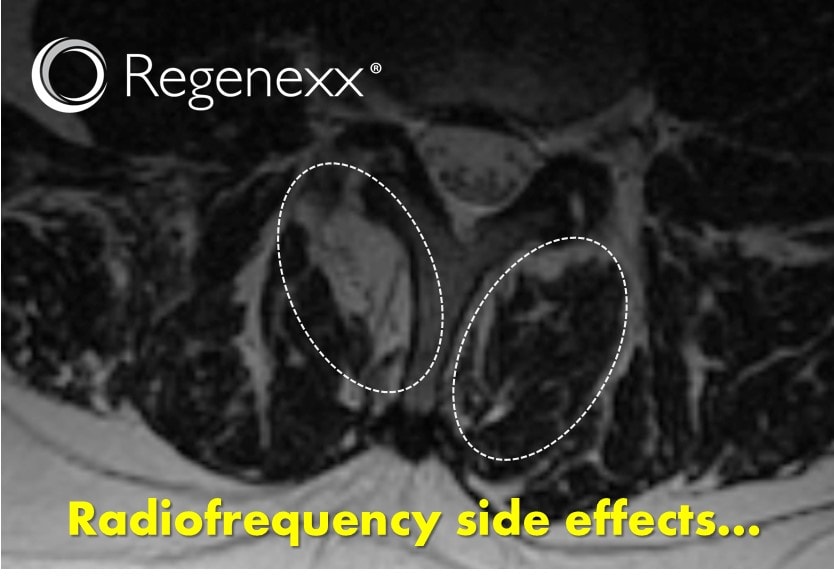 Rhizotomy Side Effects