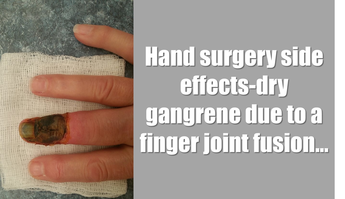 hand surgery side effects