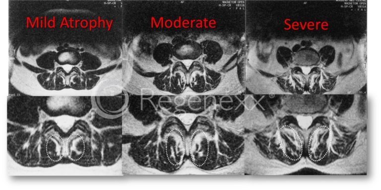 Microgravity and the Most Important Low Back Muscle Called Multifidus ...