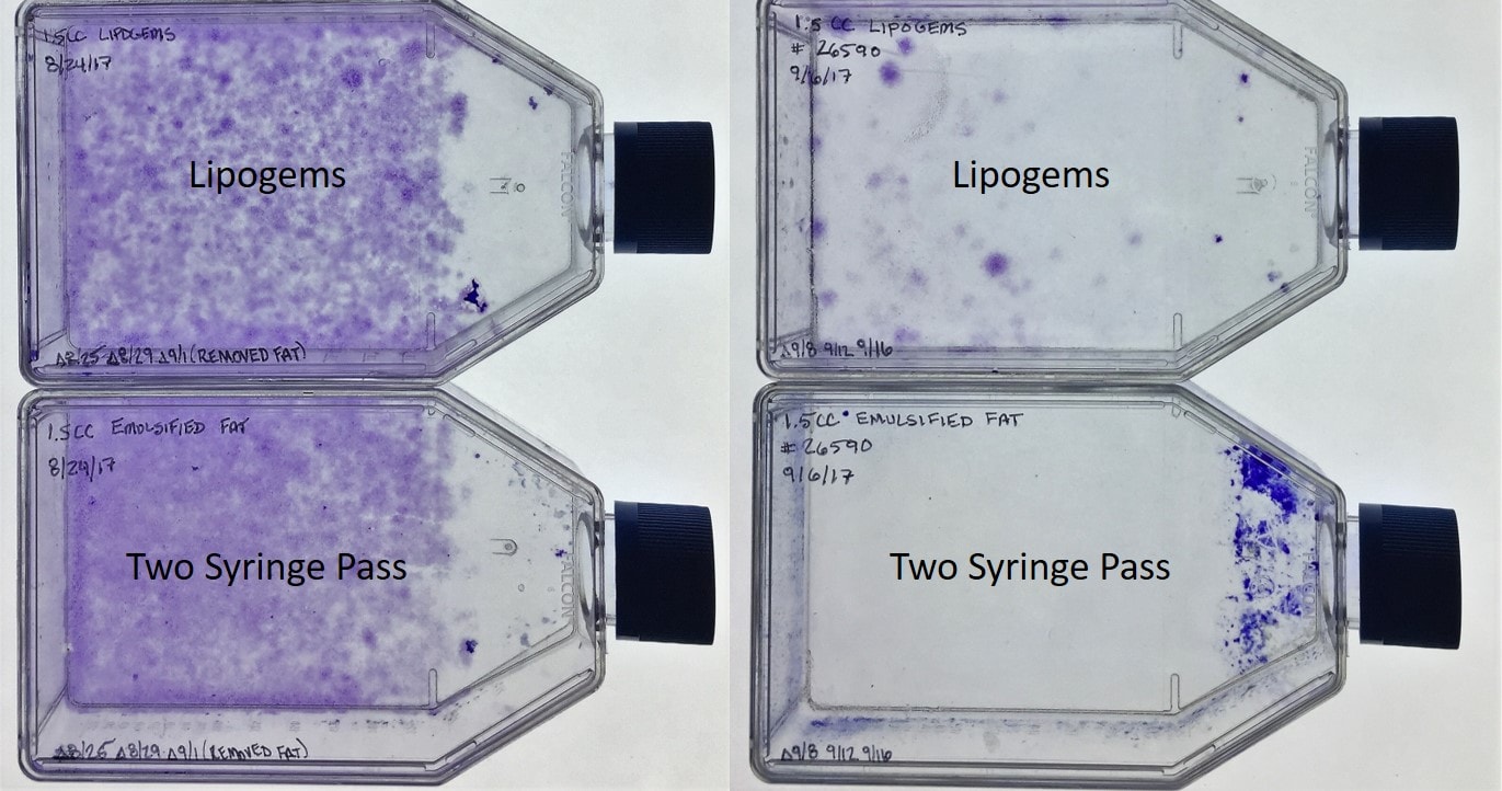 lipogems review fat stem cell procedure