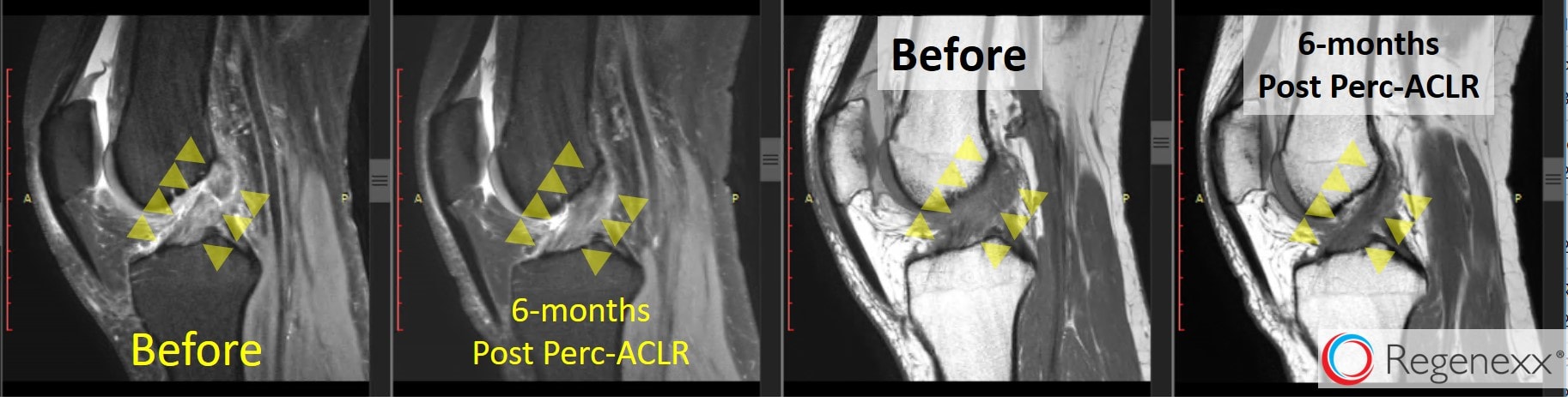 healing another acl tear precise injection stem cells