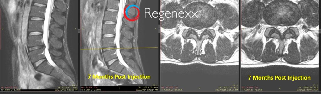 lower back stem cell injection