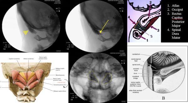 ccj instability rectus capitus posterior minor