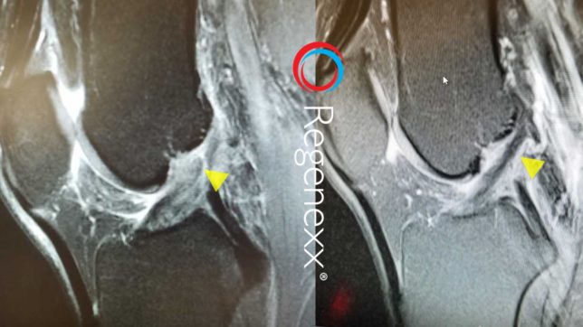 Stem Cell Therapy For ACL Tears | Non-Surgical Treatment
