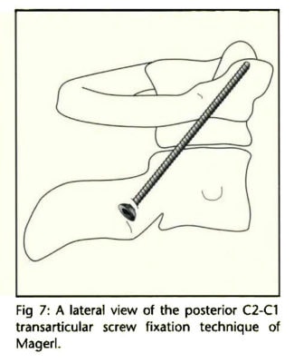 C1-C2 screw fixation|C1-C2 screw fixation
