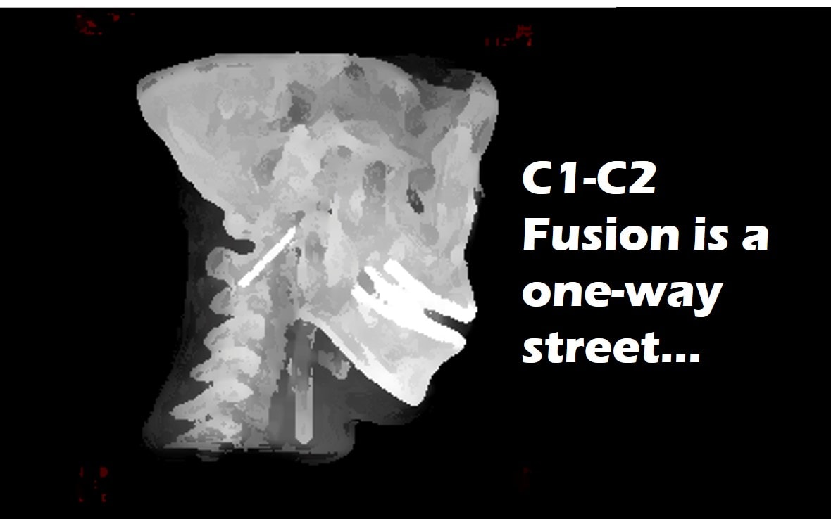 C1-C2 screw fixation|C1-C2 screw fixation