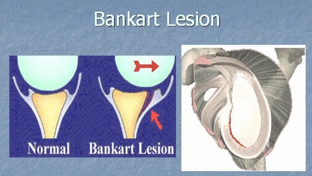 shoulder dislocation surgery pros and cons|shoulder dislocation surgery ...