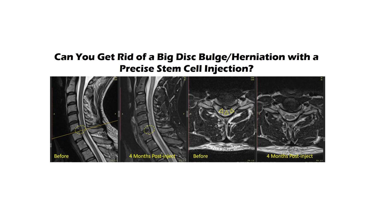 can you get rid of a cervical disc bulge with an injection of bone ...