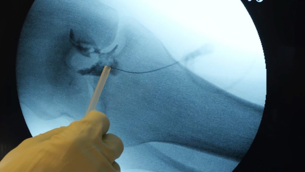 Procedure Videos - Regenexx