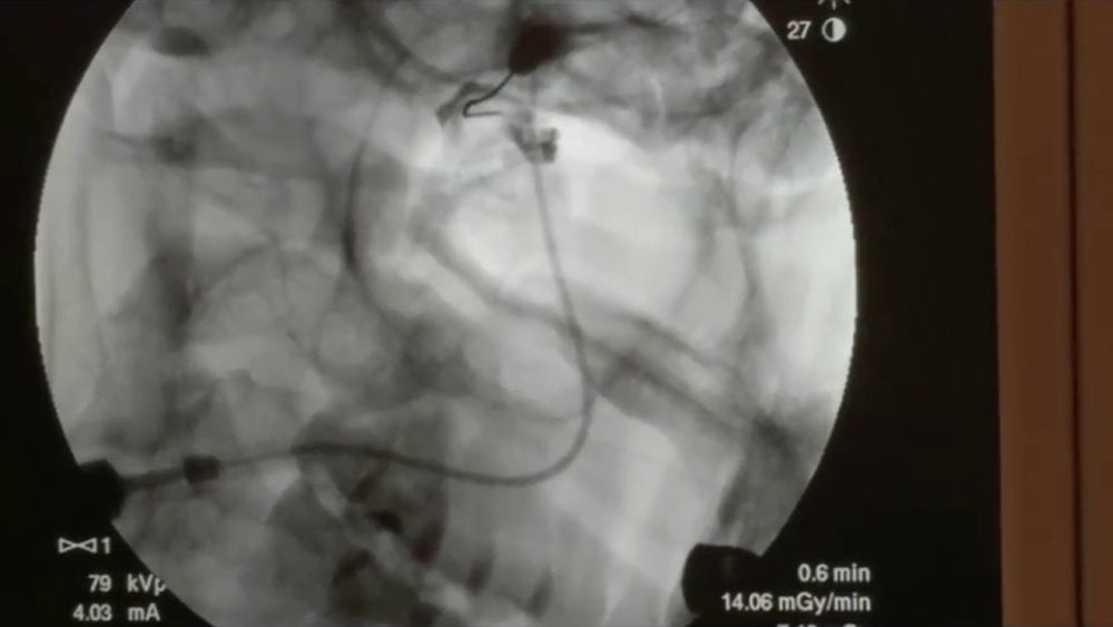 Procedure Videos - Regenexx