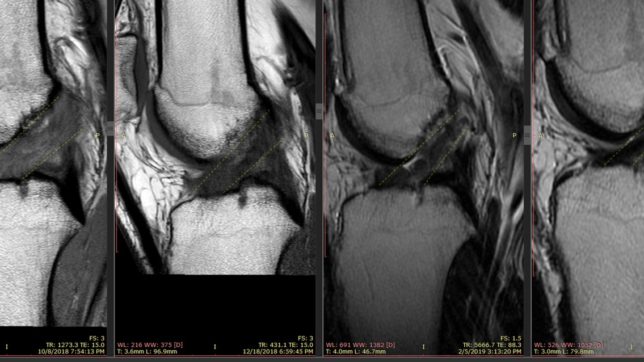 ACL Injuries Treatment Options Recovery and Resources - Regenexx Blog