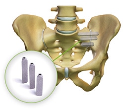 SI Joint Fusion: Does This Work? | Regenexx Blog