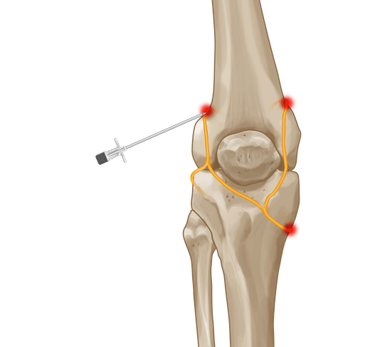 nerve ablation knee