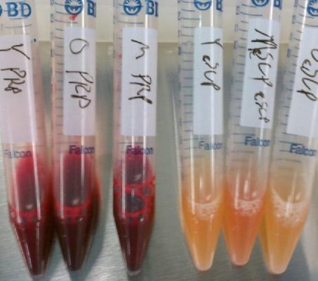 What's the Average Recovery Time After a PRP Injection?