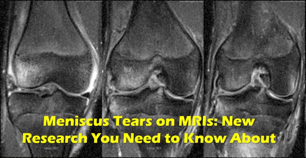 Meniscus Tear MRI Please Read This Meniscus Tear MRI Please Read This