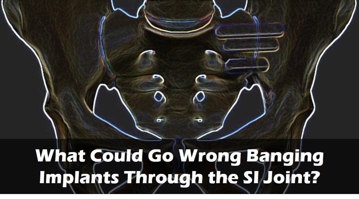 Is the SI Bone iFuse Implant a Good Thing?