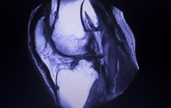 Meniscus Tear MRI: Understanding Knee Health
