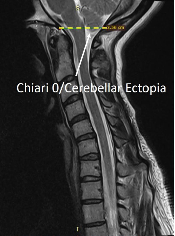 Chiari malformation treatment