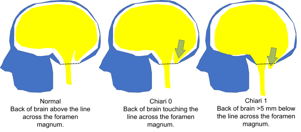 Chiari malformation treatment