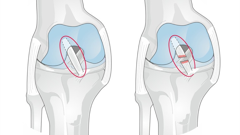 ACL Reconstruction Surgery Is a Second Hit to the Cartilage: Time to ...