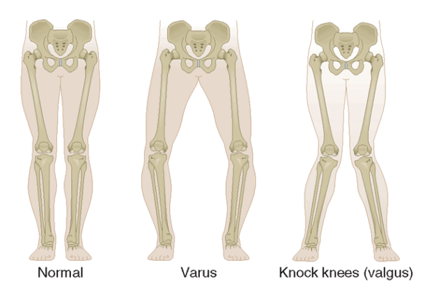 Can You Treat A Valgus Knee With Severe Arthirtis Without Surgery Regenexx