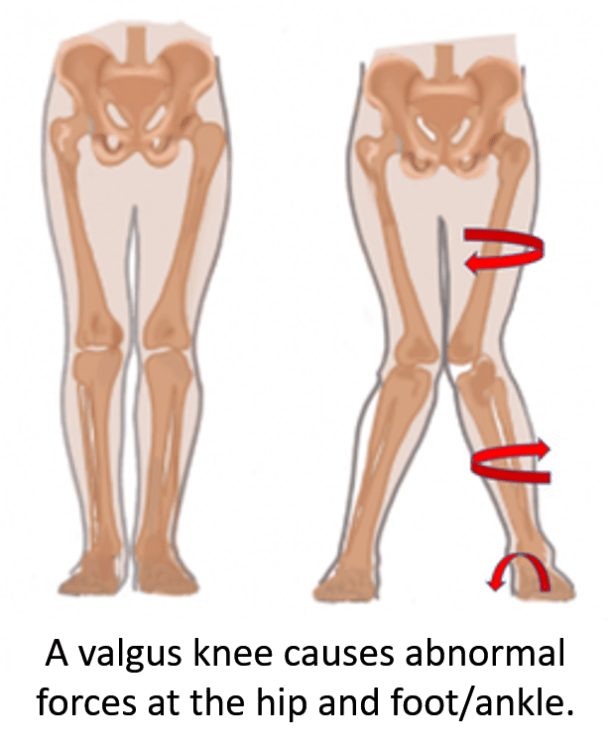 Can You Treat A Valgus Knee Without Surgery Regenexx