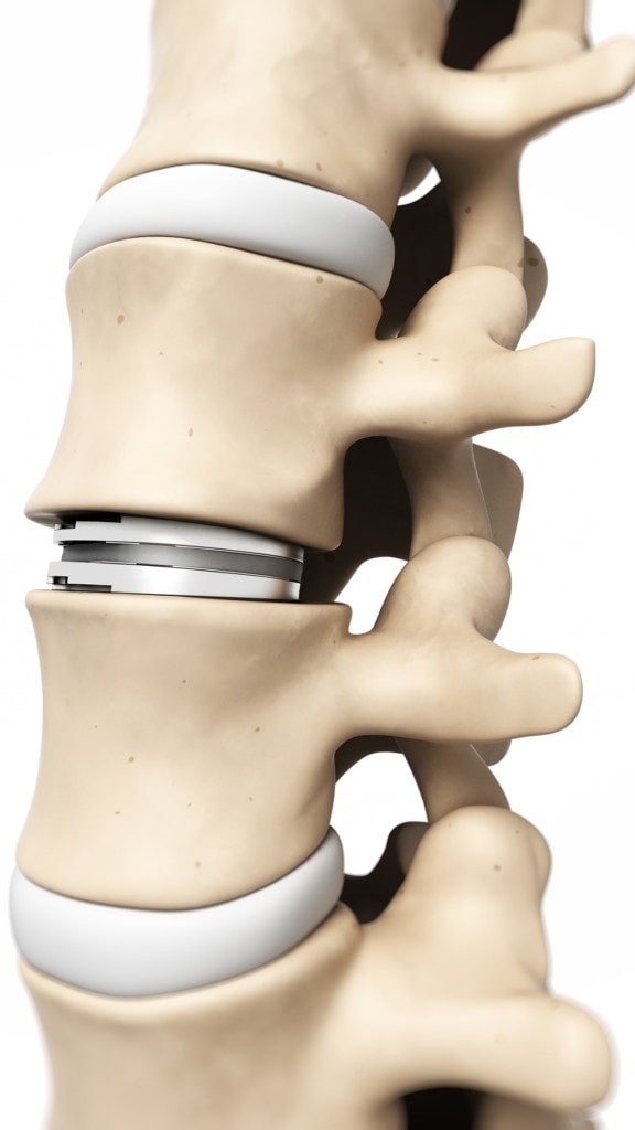 What Are the Problems With Artificial Disc Replacement? - Regenexx