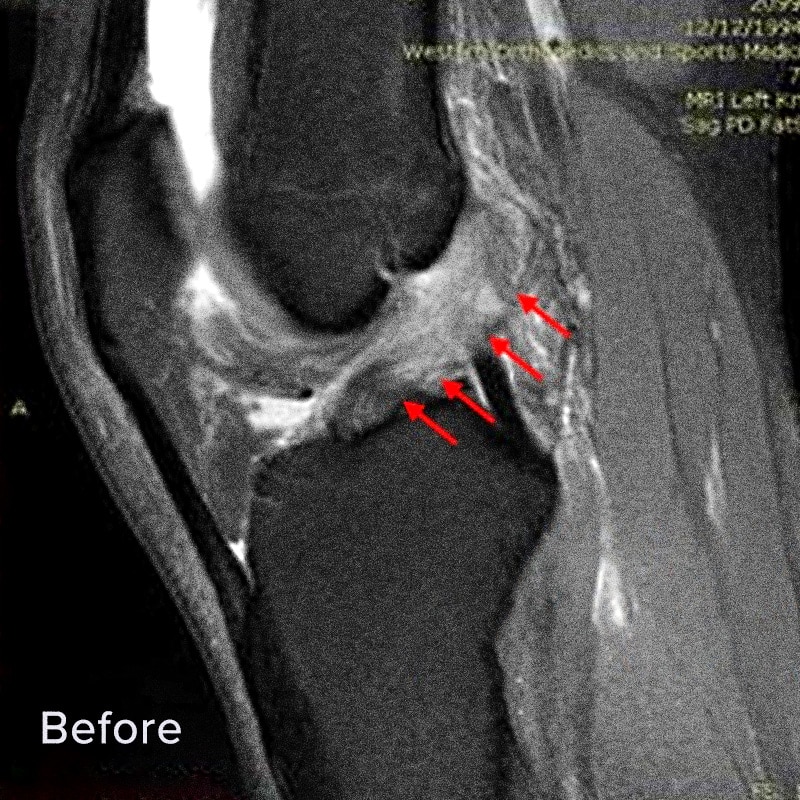 ACL Tear Repair Without Surgery Regenexx ACL Tear Repair Without Surgery Regenexx