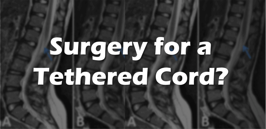 Surgery for Tethered Cord in Adults? - Regenexx