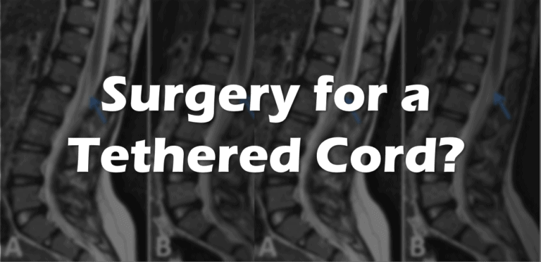Surgery for Tethered Cord in Adults? - Regenexx