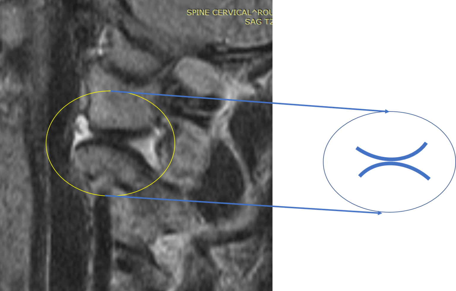 Why the C1-C2 Facet Joint Is Inherently Unstable - Regenexx