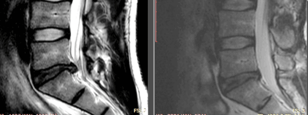 L5-S1 Non-surgical Disc Treatment - Regenexx