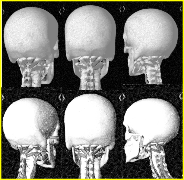 New Craniocervical Instability Book! - Regenexx