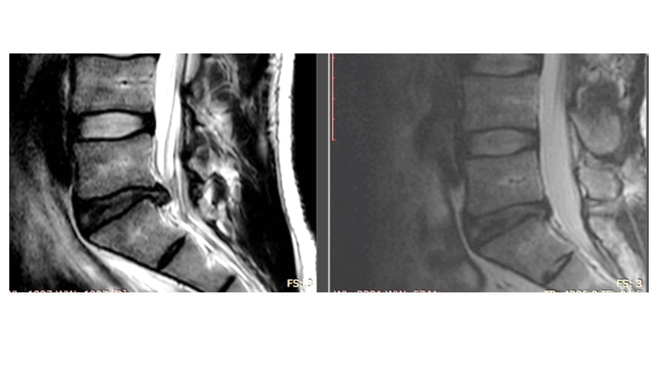 L5-S1 Non-surgical Disc Treatment - Regenexx