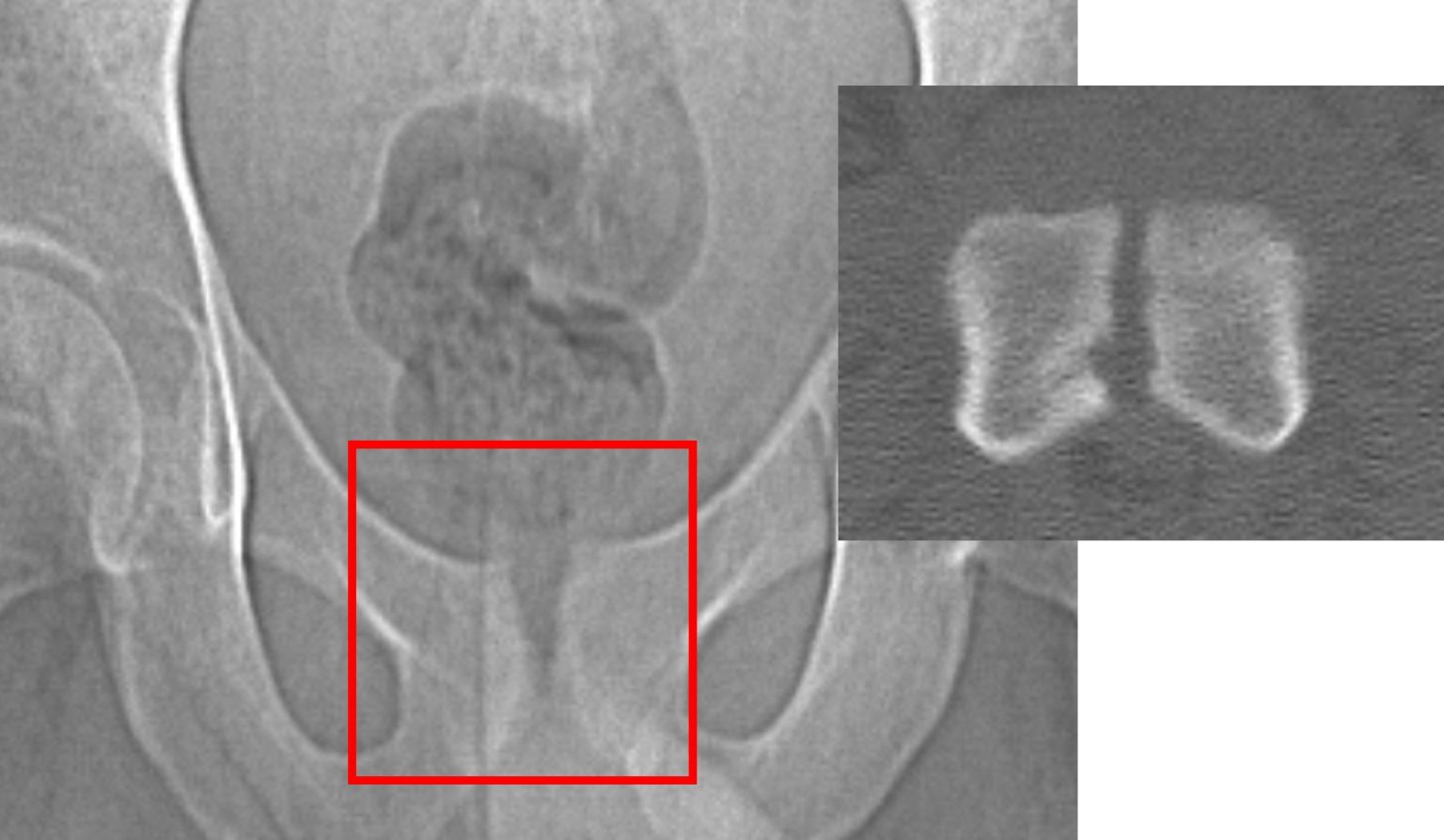 What Is Osteitis Pubis Can It Be Fixed Regenexx