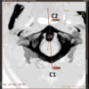 Jugular Vein Compression Due to the Neck and CCI - Regenexx