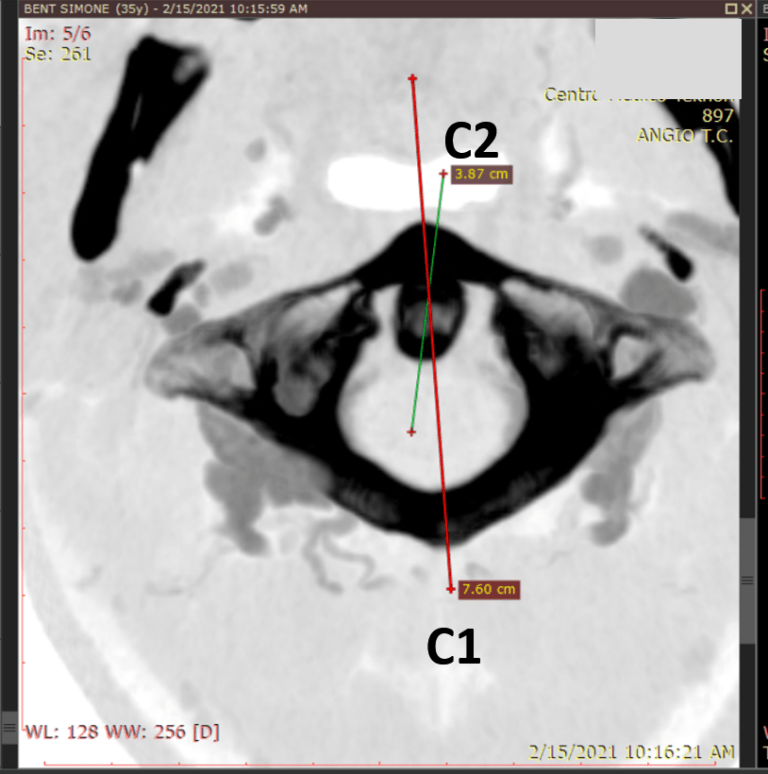 Jugular Vein Compression Due to the Neck and CCI - Regenexx