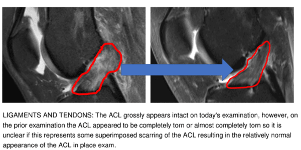 A Confused Radiologist and an Improved ACL? - Regenexx