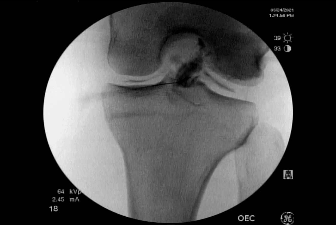 A Confused Radiologist and an Improved ACL? - Regenexx