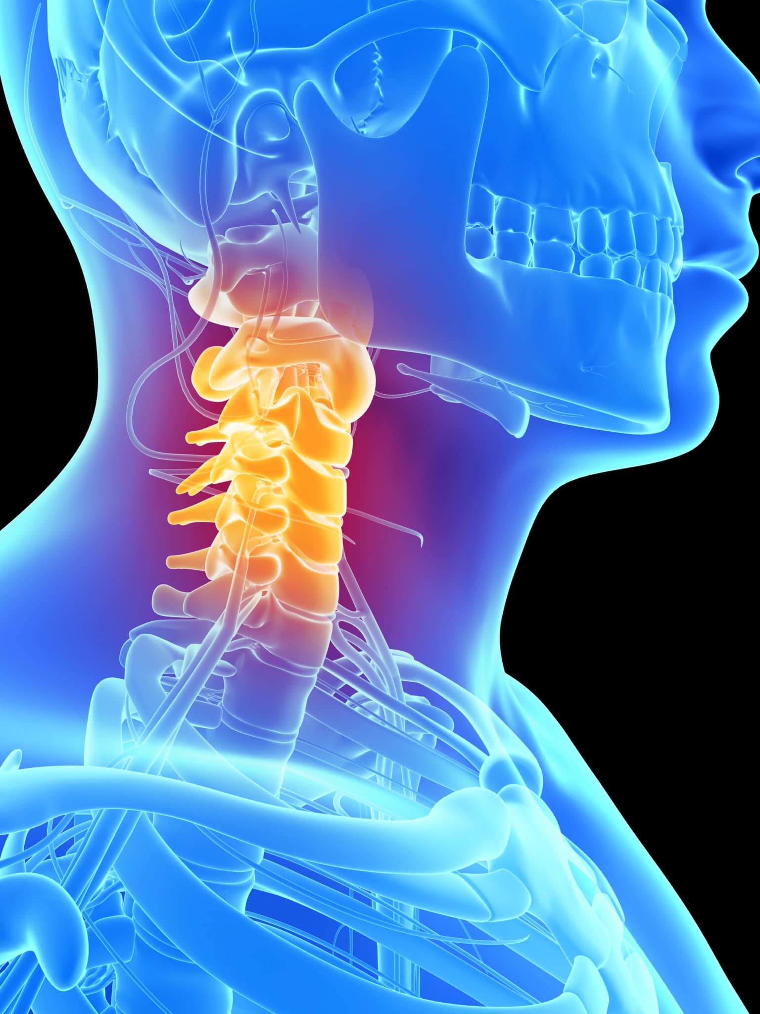 Surgically Damaging the Neck - Regenexx