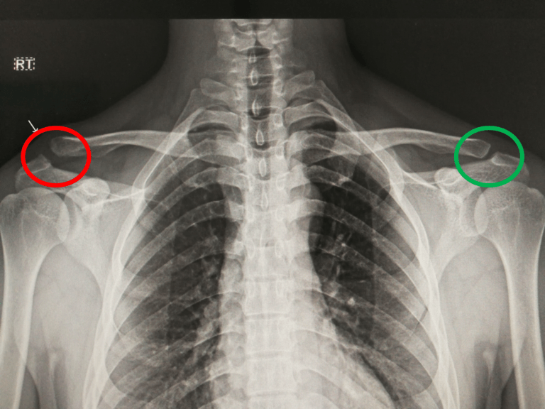 Another One Bites the Dust: Surgery for AC Separation - Regenexx