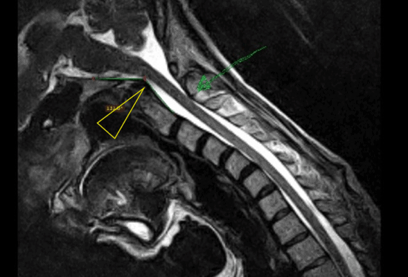 Using Upright Cervical MRI to Diagnose CCI - Regenexx