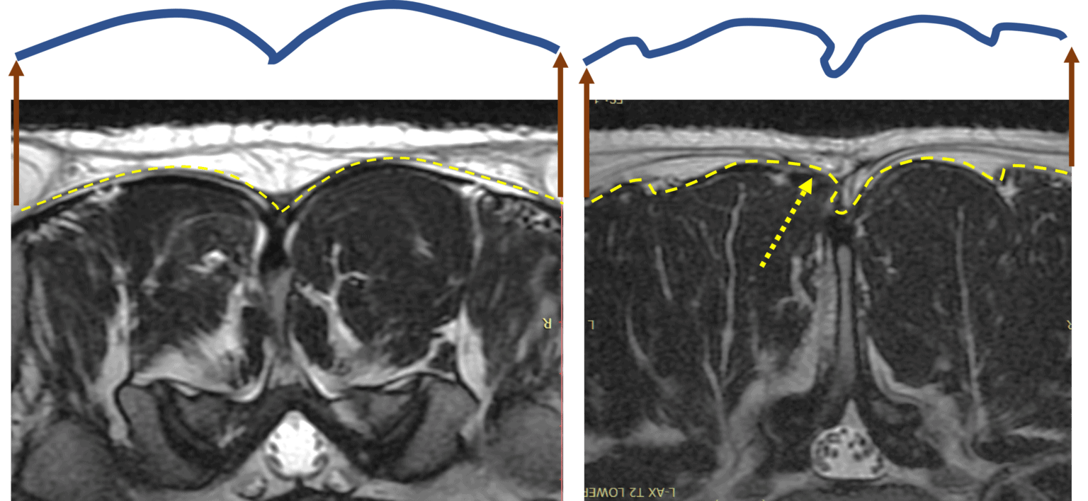 Does Low Back Surgery Cause Damage to the Fascia? What Is the Fascia ...